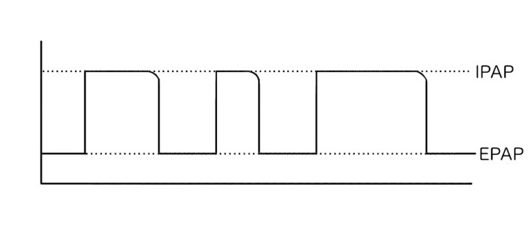 NPPVのモードの基本｜Sモードの特徴や適応を知る | キカイガキライ